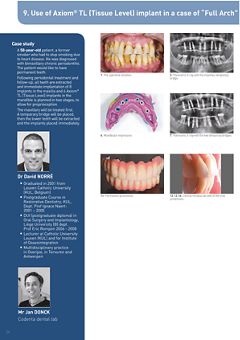 Axiom® Tissue Level - Dental Implants | Anthogyr
