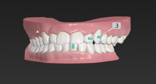 How I used ClearCorrect to treat an ortho restorative case