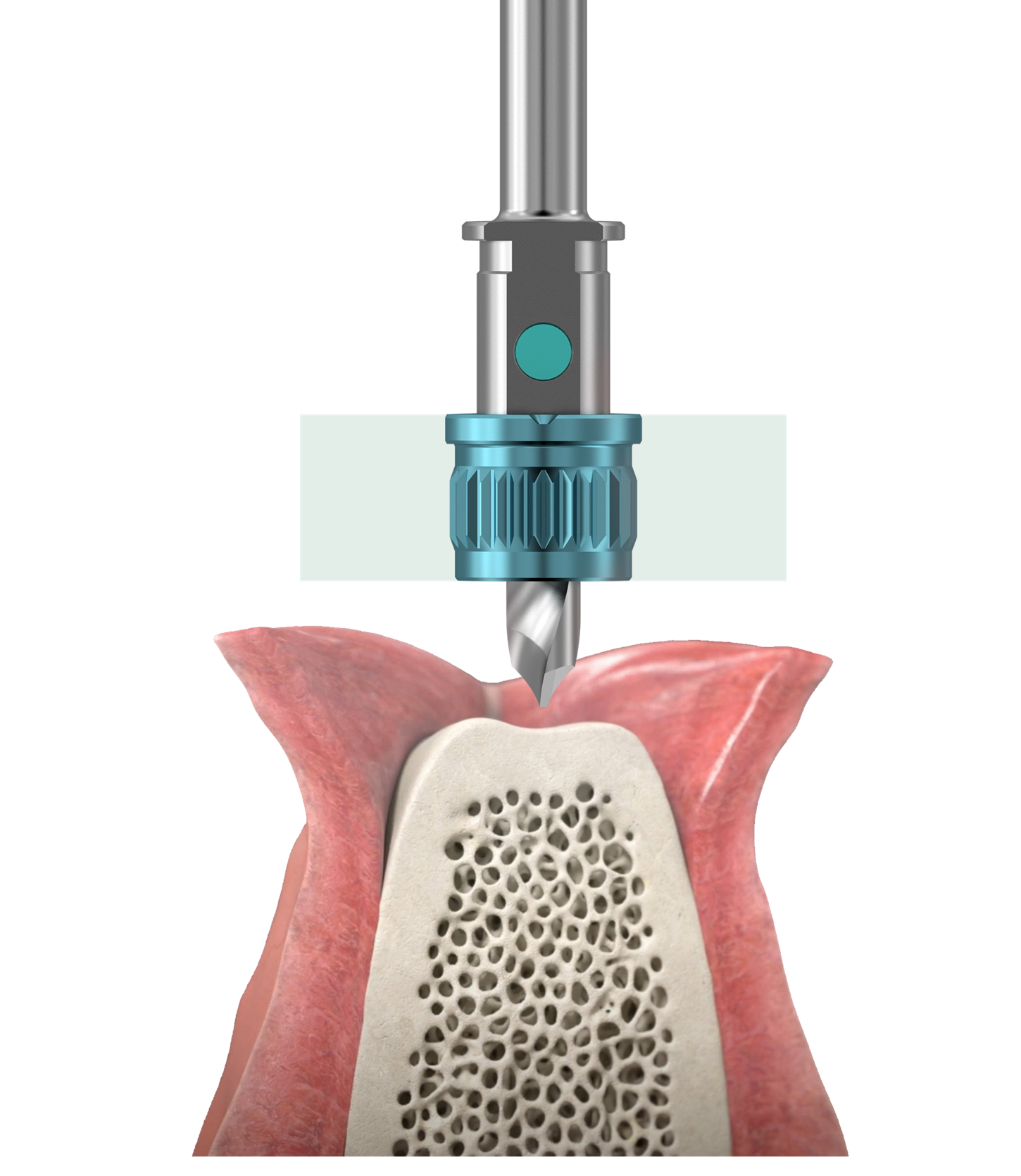 INTEGRAL Guided Surgery | Dentalimplantate | Anthogyr