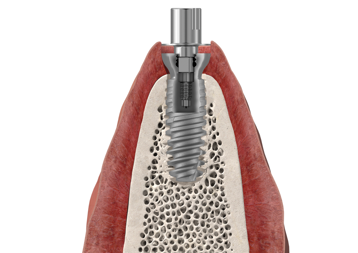 Axiom® Tissue Level - Dental Implants | Anthogyr