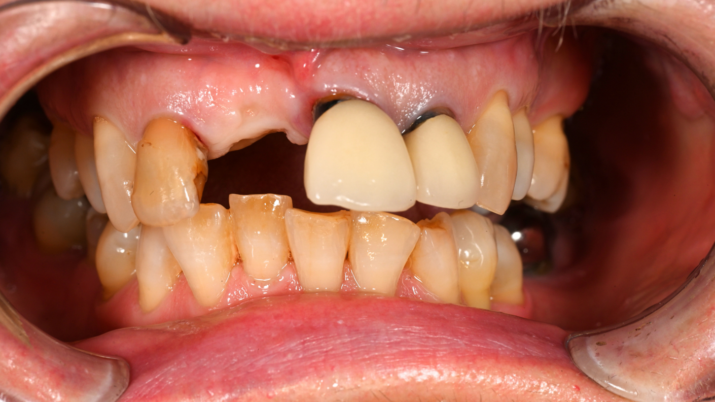 Axiom X3® Bone Level – Clinical Case – Dr Océan Fumery