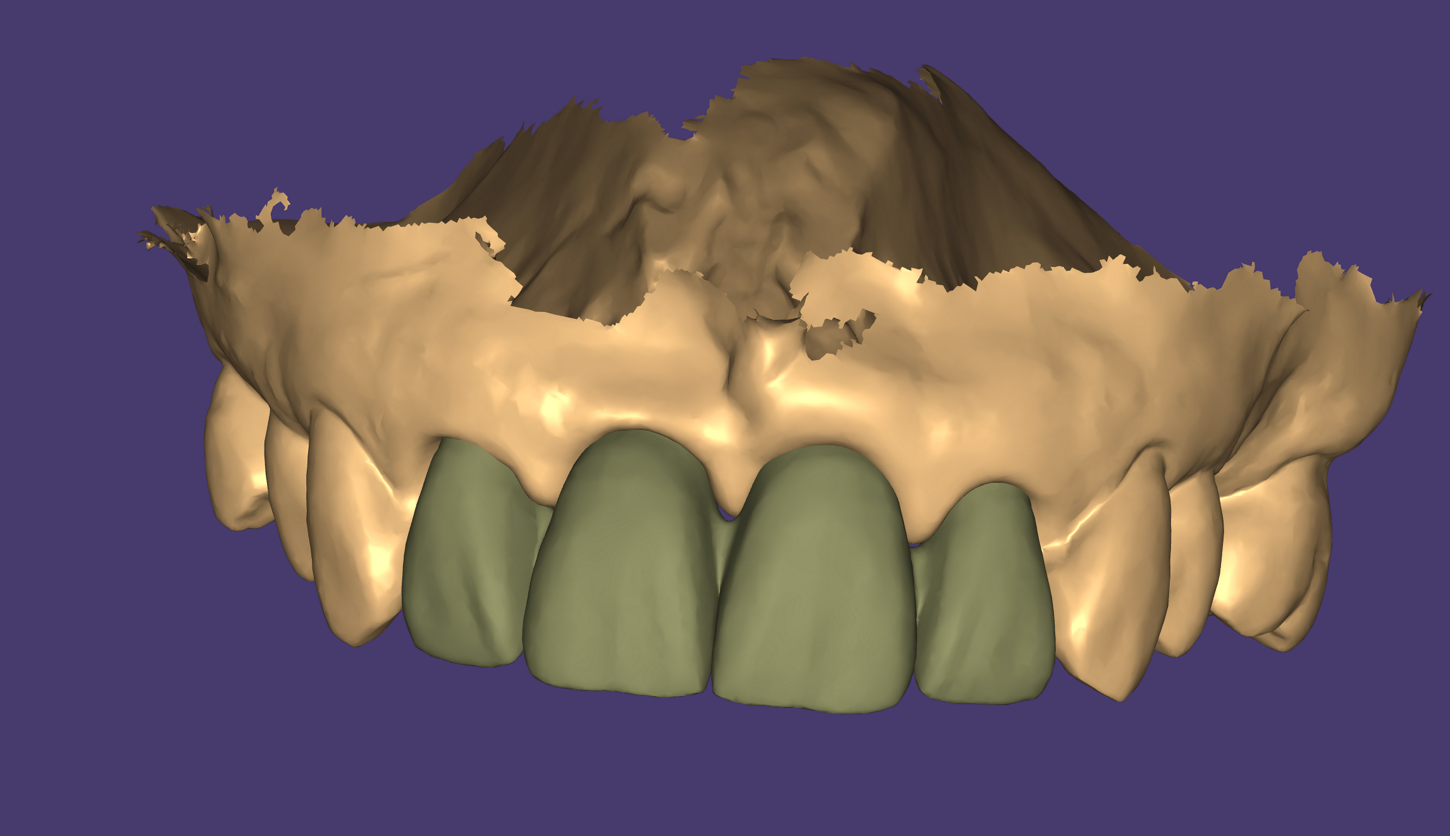 Axiom X3® Bone Level – Clinical Case – Dr Océan Fumery
