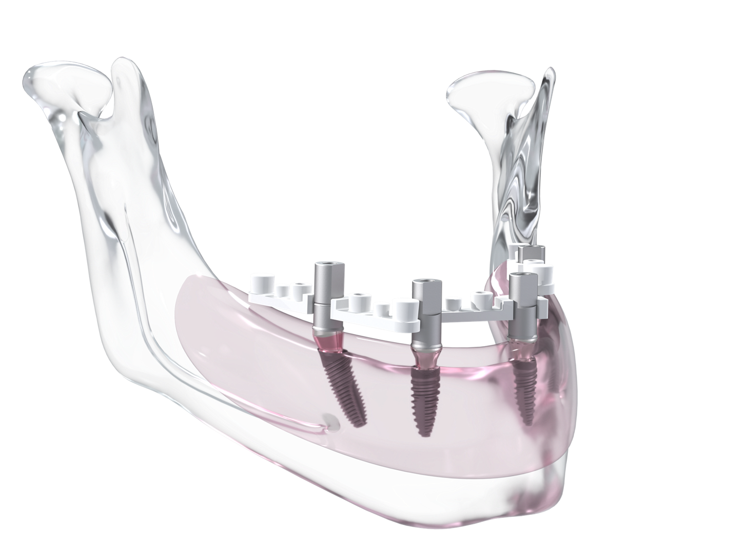 Scanbodies für genaue digitale Abformungen | Medentika