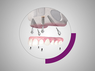 Neodent for Dental Professionals