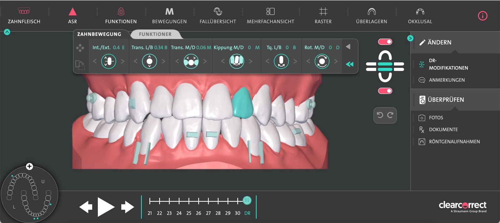 Das Ergebnis mit Alignern nicht dem Zufall überlassen