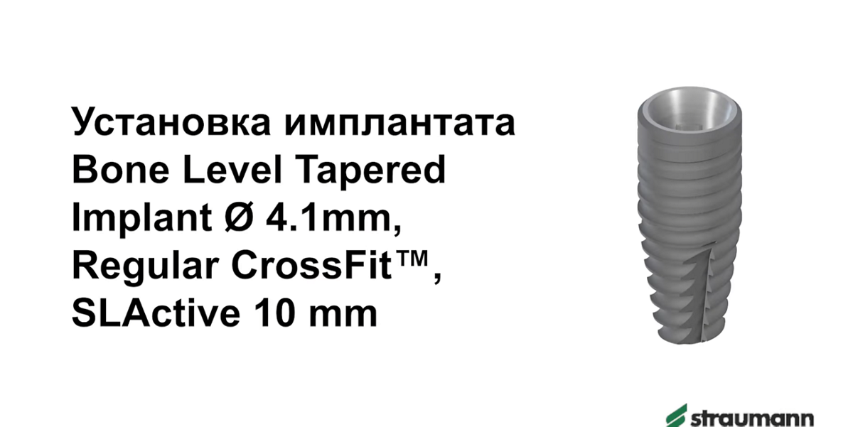 Установка имплантата: Straumann® Bone Level Tapered