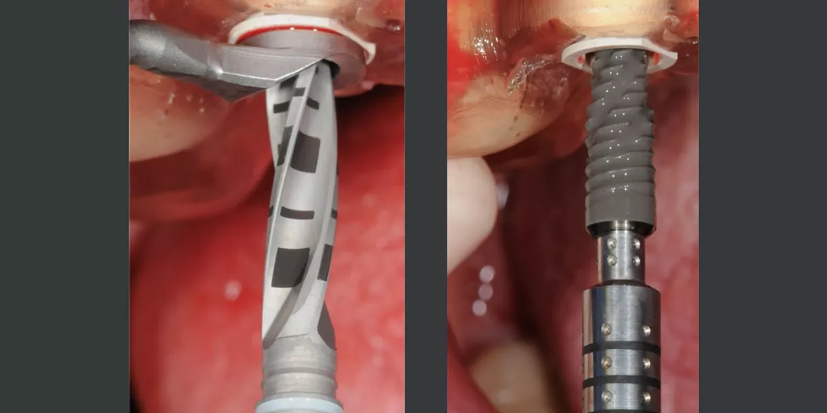 Straumann® BLC® | Clinical Case Dr. France Lambert