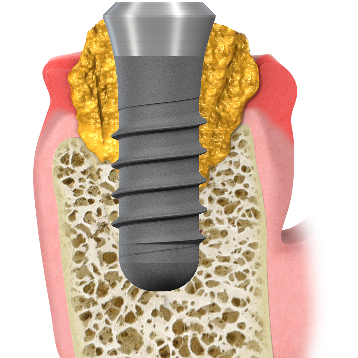 Peri-implantitis