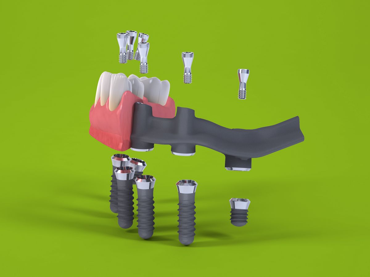 Did you know? Facts about Straumann® Pro Arch – the solution for ...