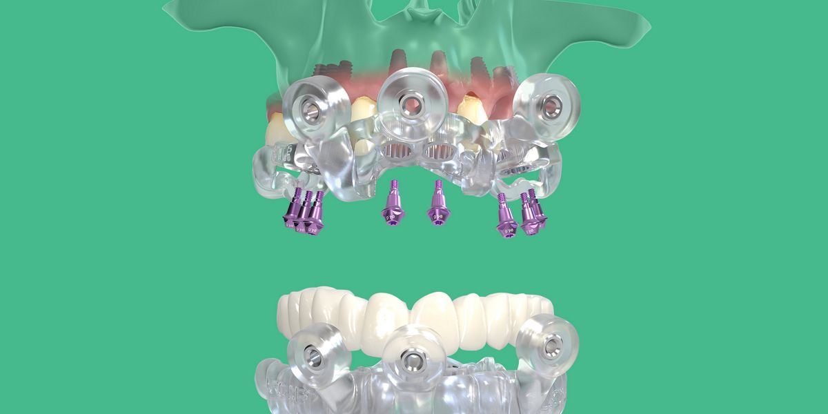 Straumann® STARconcept™