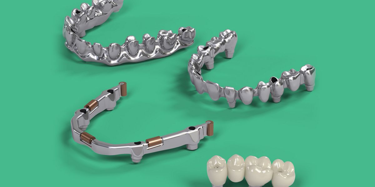 Fixed Screw-retained Bars and Bridges