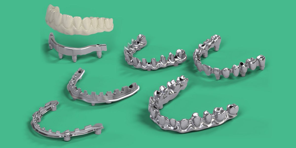 Removable Screw-Retained Bars and Bridges - Straumann UN!Q