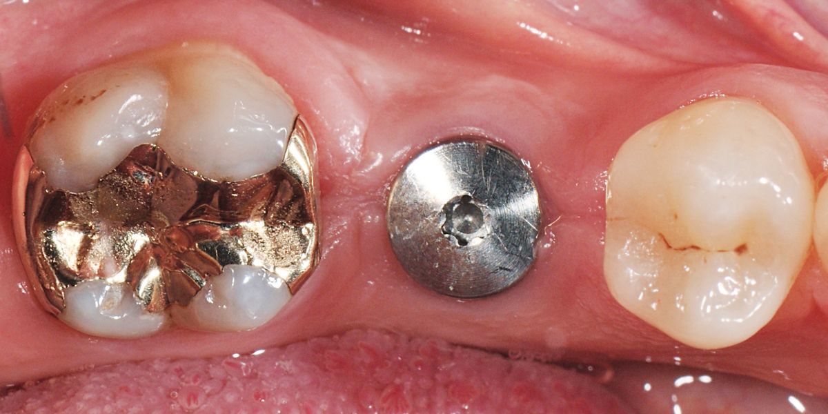 Abutment selection and long-term success