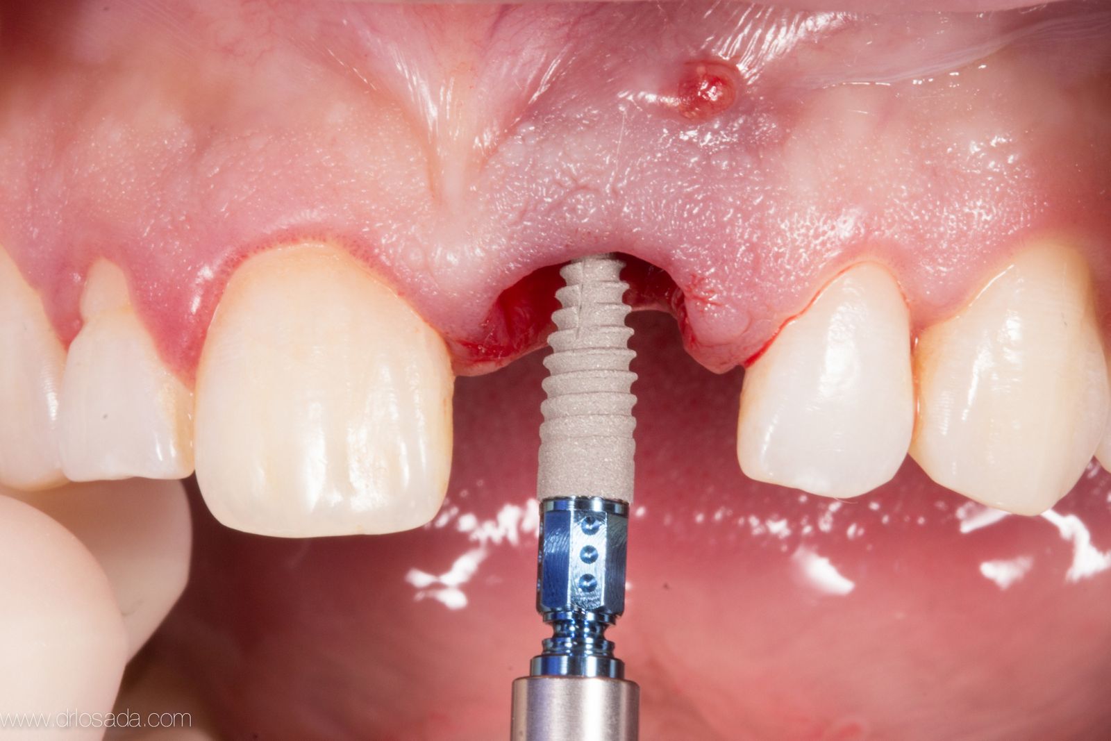 Immediate Implant With Immediate Provisioning And, 49% OFF