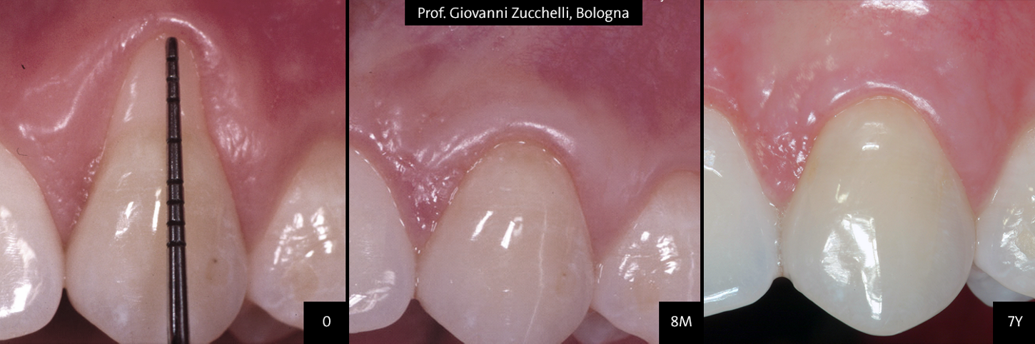 mucogingival defect examples