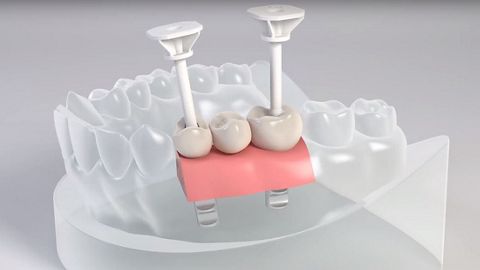 Implant-borne prosthetics