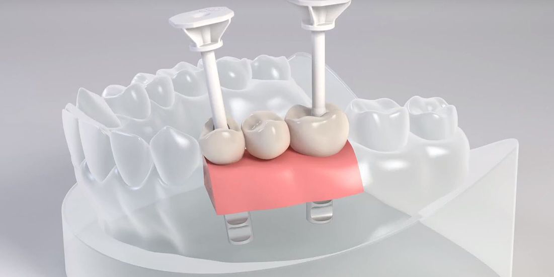 Cementation Aid for Straumann® Variobase® for Bridge/Bar Cylindrical