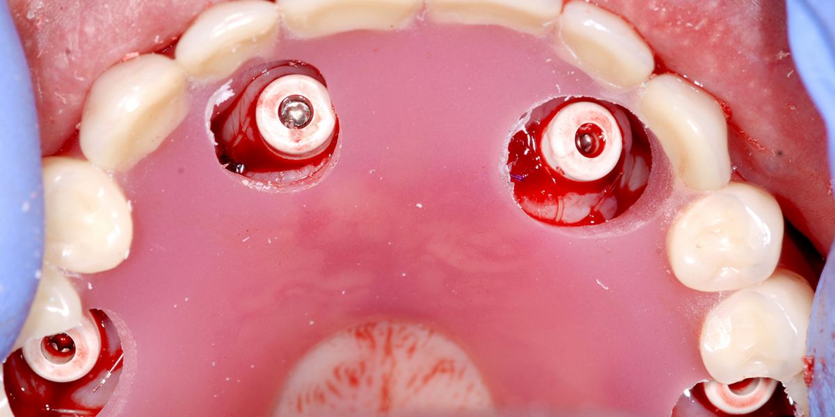 Straumann® Pro Arch. Rehabilitation of the edentulous maxilla with four ...