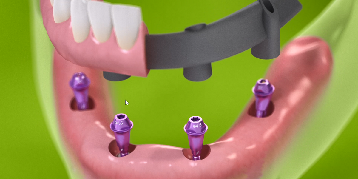 The top 7 reasons to use Straumann Pro Arch with the new Straumann® BLX ...