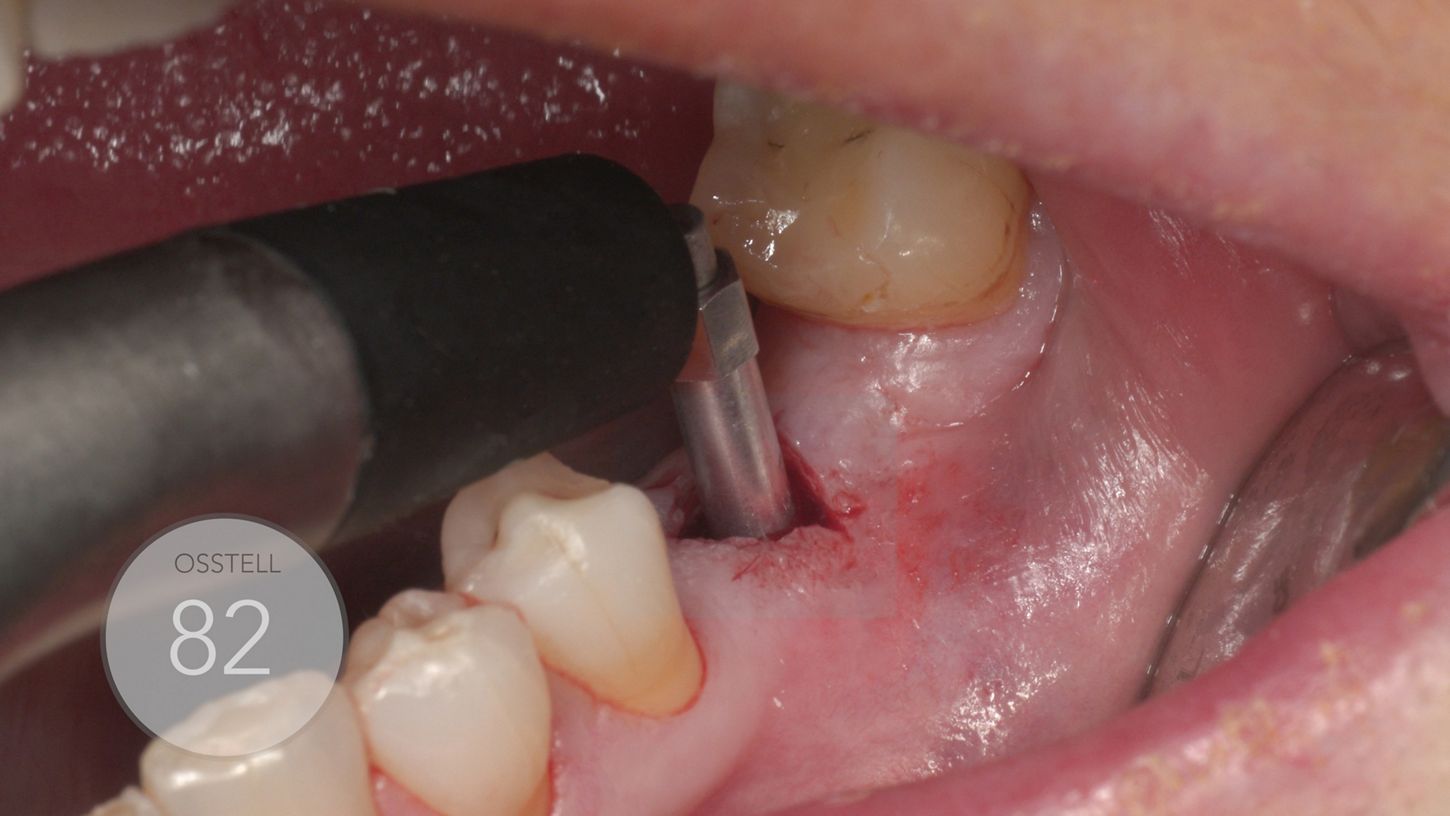Conventional and immediate loading with final n!ce® Screw-Retained Crowns with the Straumann ...