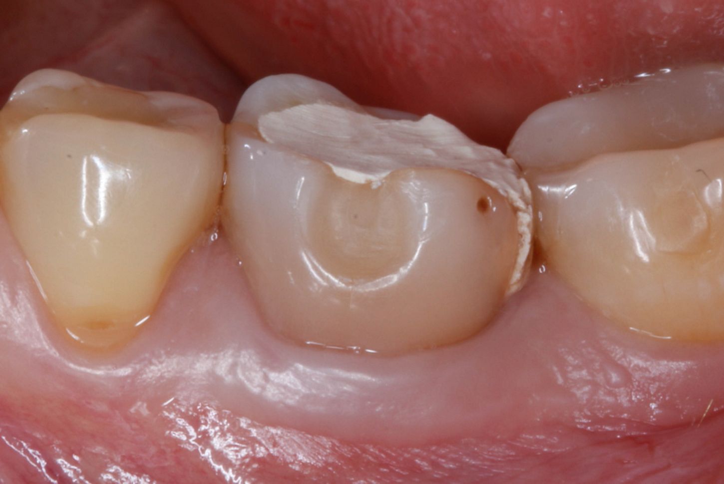 interradicular septum teeth