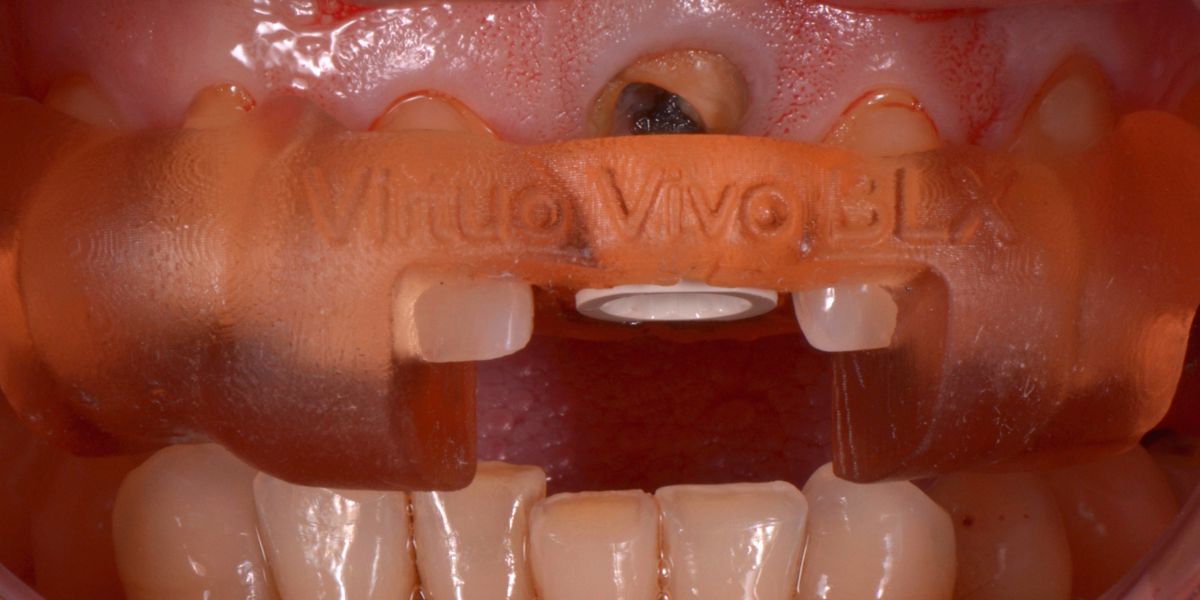 Immediate loading of post-extraction implant in a high-esthetic value ...