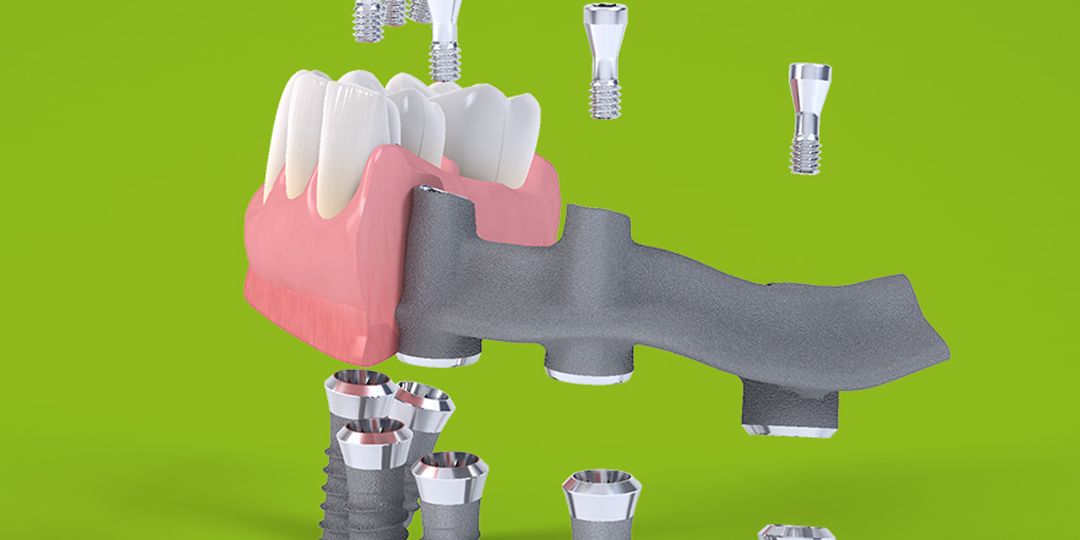 The fully digital model-free monolithic Pro Arch with Straumann® BLX