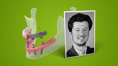 Solutions for edentulous patients