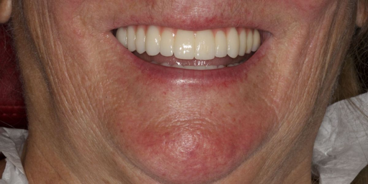 The ZAGA Concept for a minimally invasive “Canal Osteotomy” combined ...