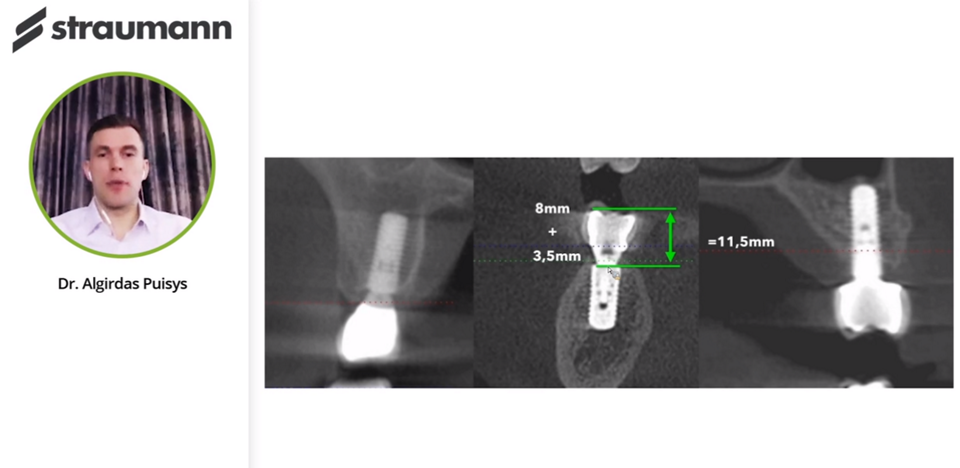 Campus Live Webinar with Dr. Algirdas Puisys: Crestal bone stability ...