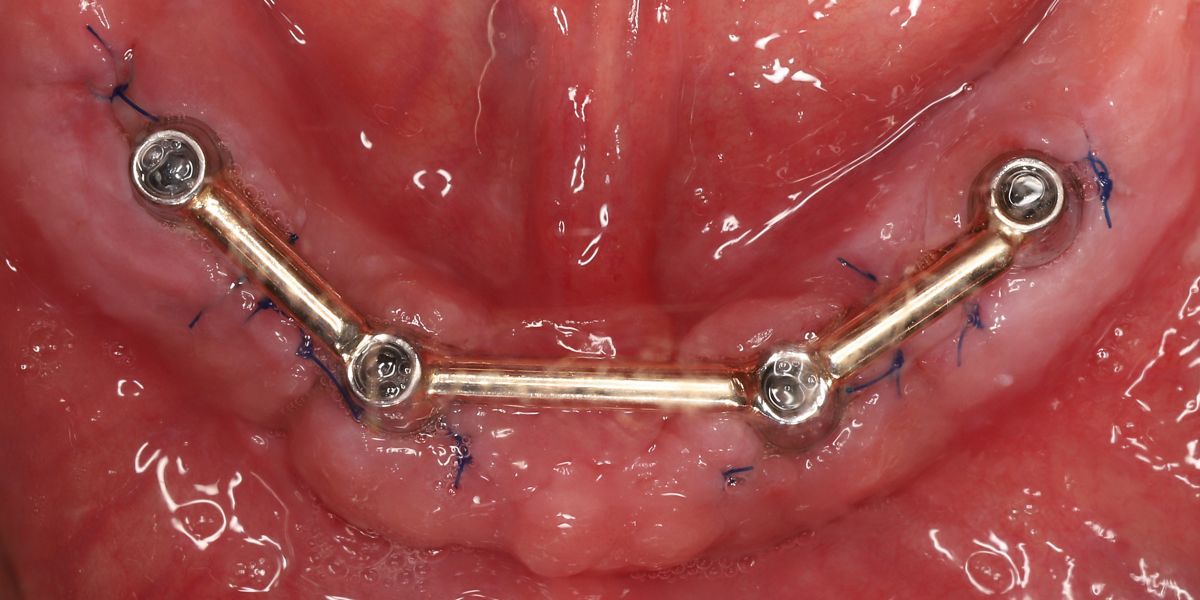 Straumann® BLX Implants Ø 3.75 mm for the immediate loading of a bar ...