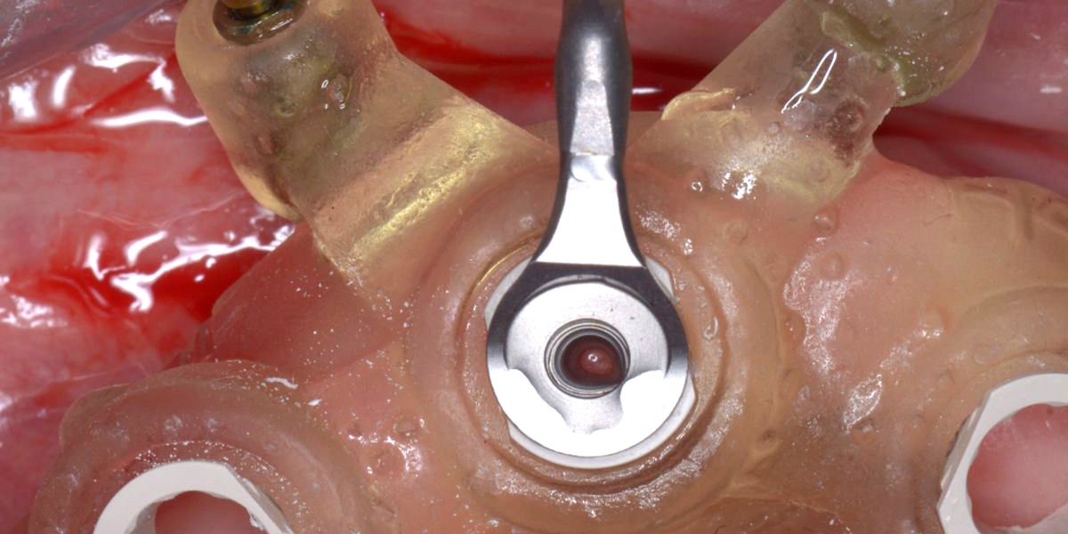 Full Edentulous Rehabilitation with Straumann® Pro Arch concept and BLX ...