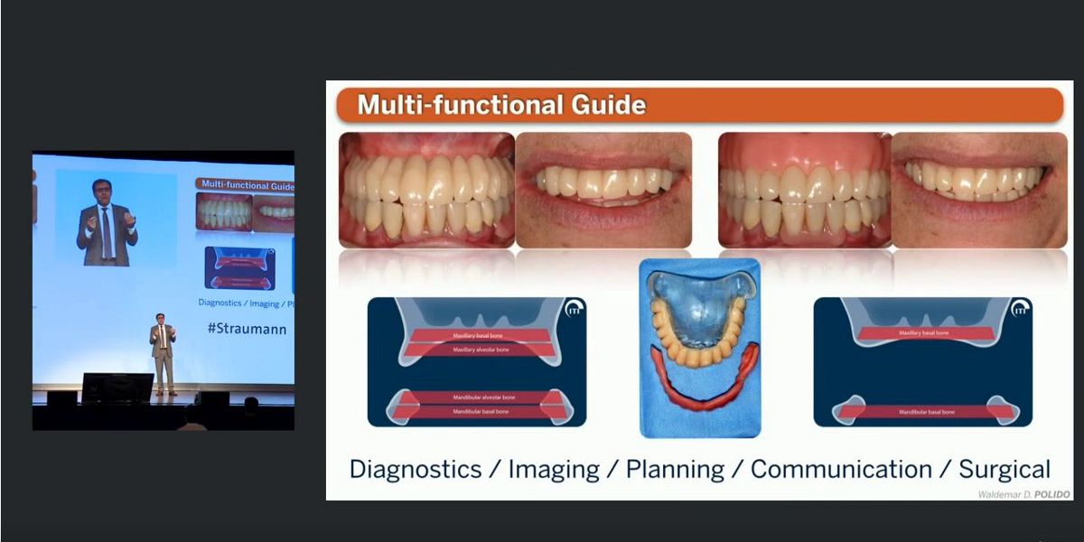Video lecture: Immediate full arch restoration using the Straumann® Pro ...