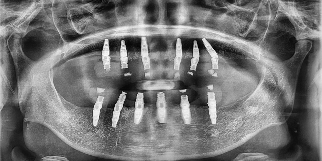 Pro Arch bi-maxillary prosthetic rehabilitation with Straumann BLT implants