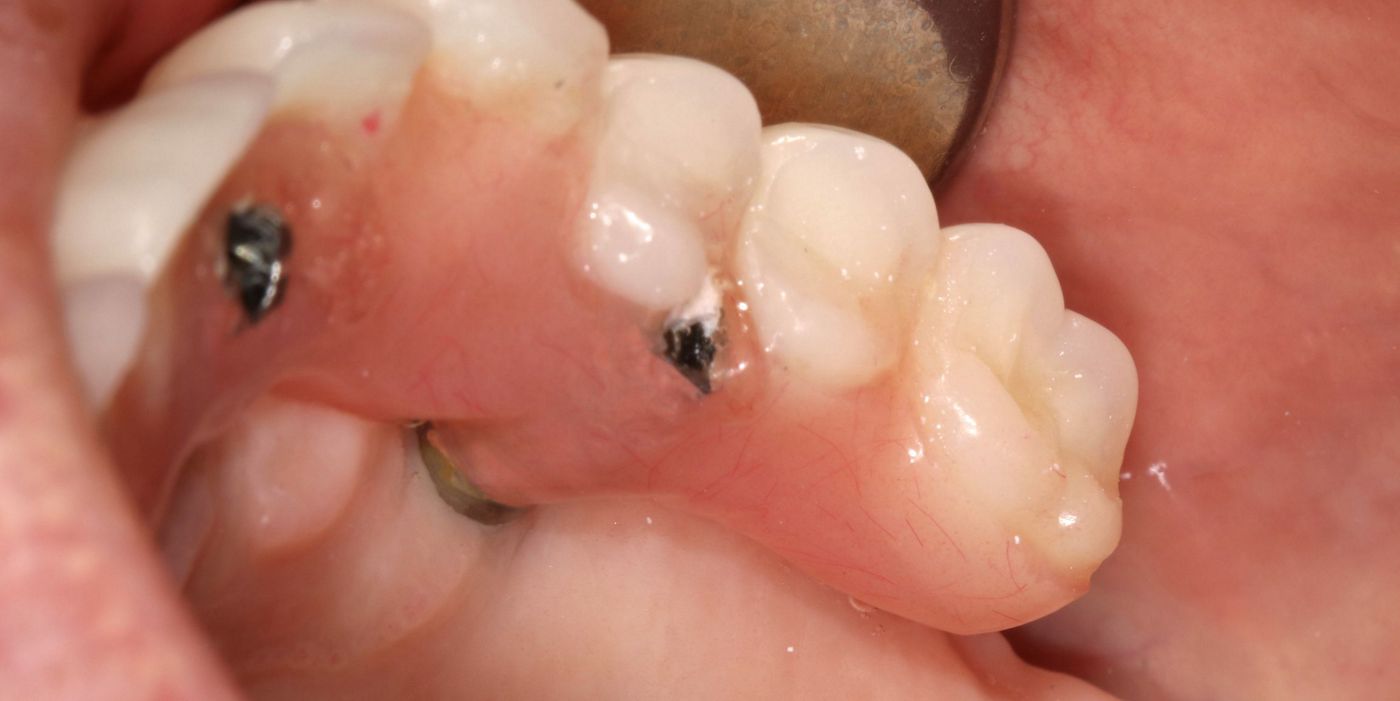 Extraocular Implant Funcage