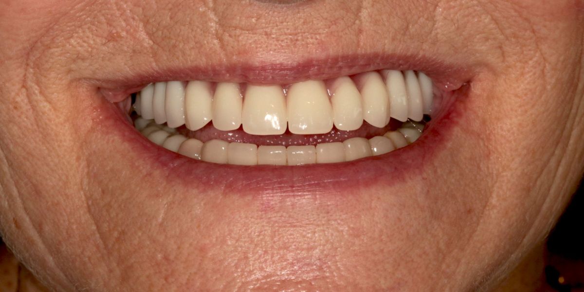 Bimaxillary full edentulous graft-less rehabilitation with Straumann ...