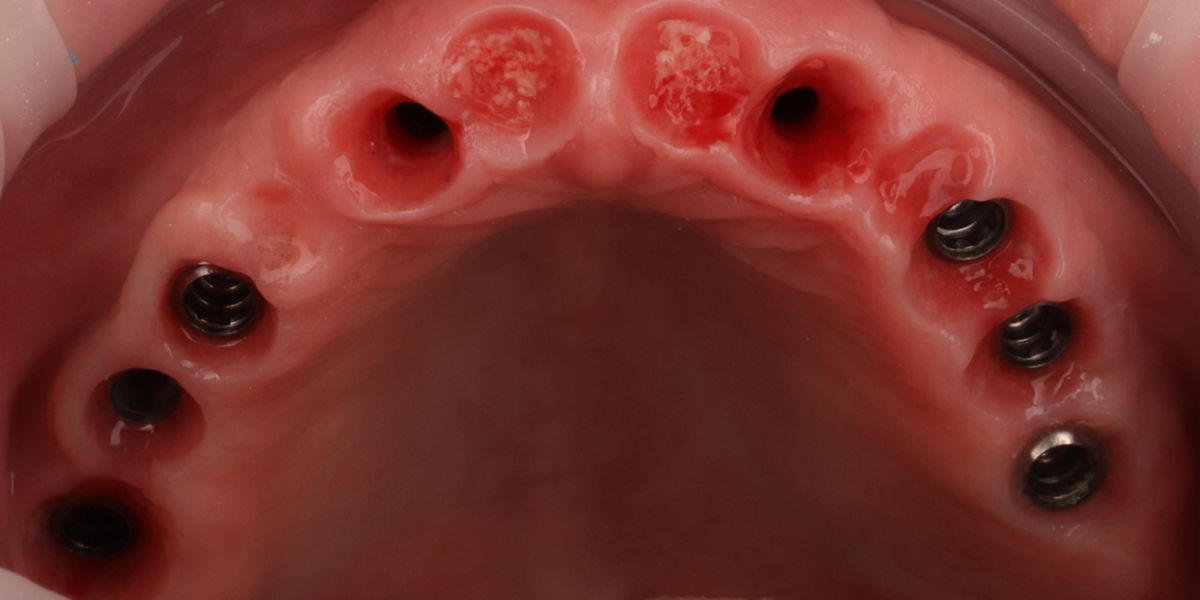 Immediate provisional restorations and loading of Straumann® Tissue ...