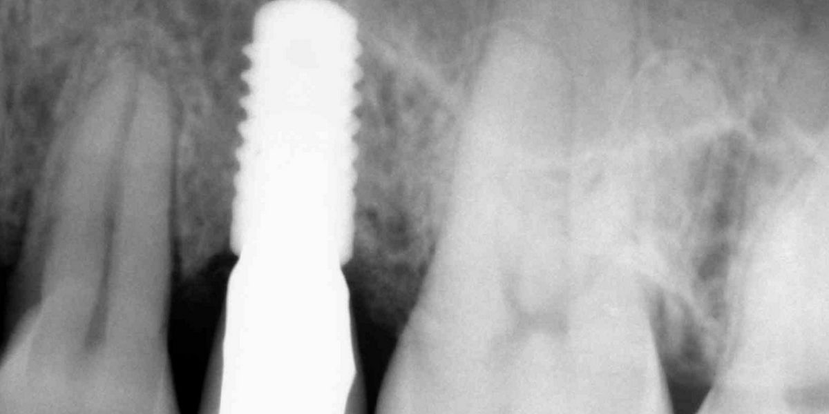 Reconstructive surgical therapy of a peri-implantitis related intrabony ...