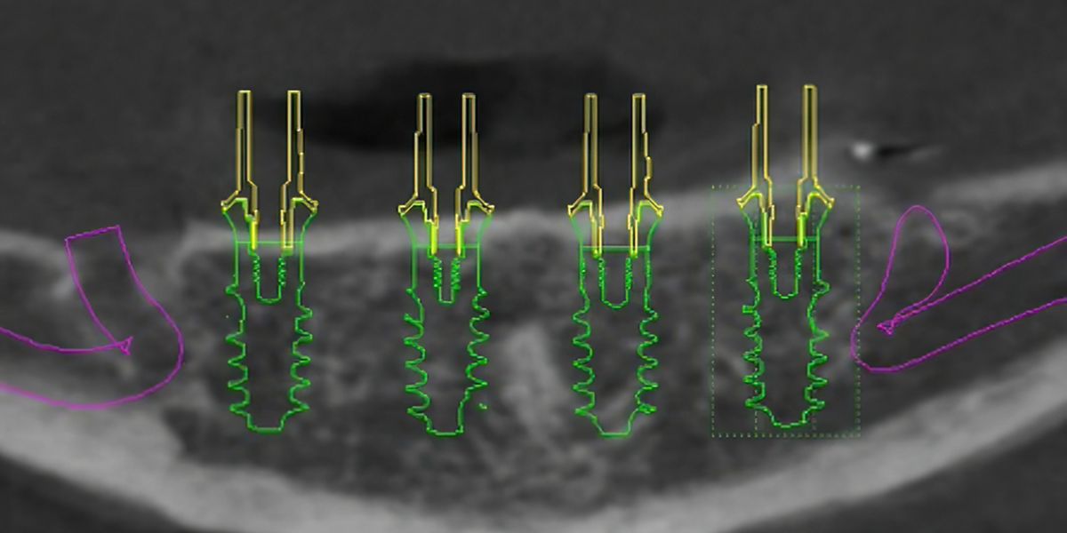 Straumann® Pro Arch TLX – a video case report
