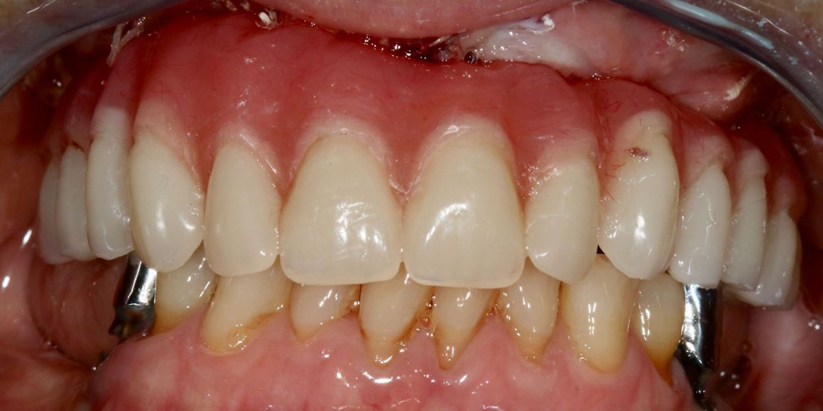 Immediate rehabilitation of a fully edentulous maxilla with regular ...