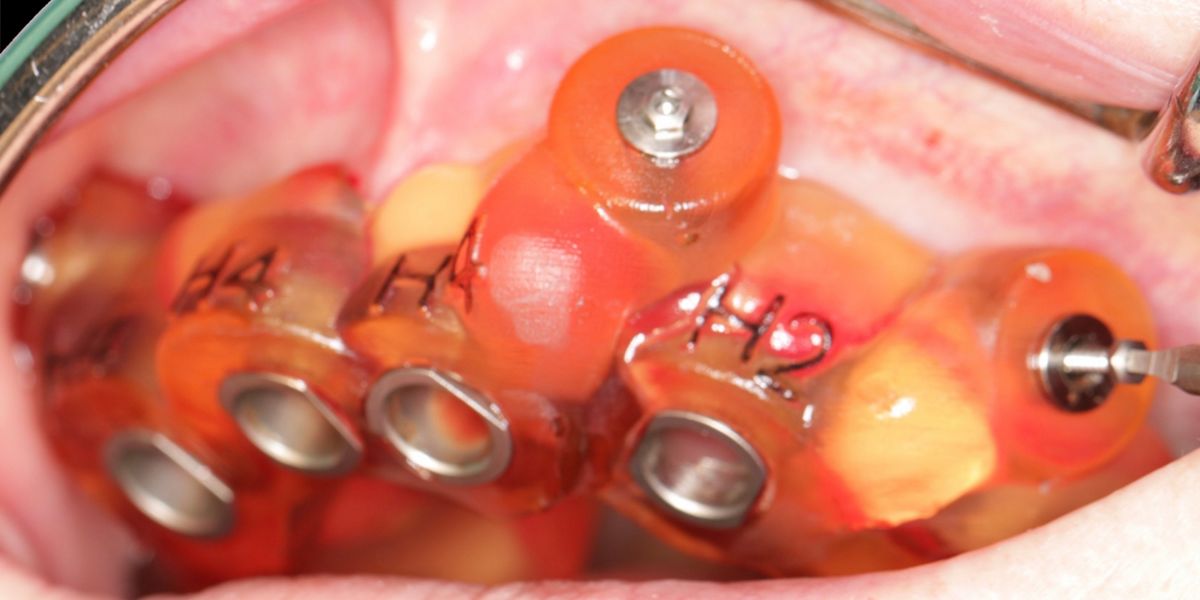 Bimaxillary full-arch rehabilitation with Straumann® PURE Ceramic ...