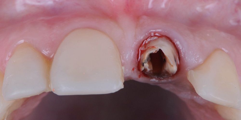 Interdisciplinary approach for anterior maxillary teeth in a young ...