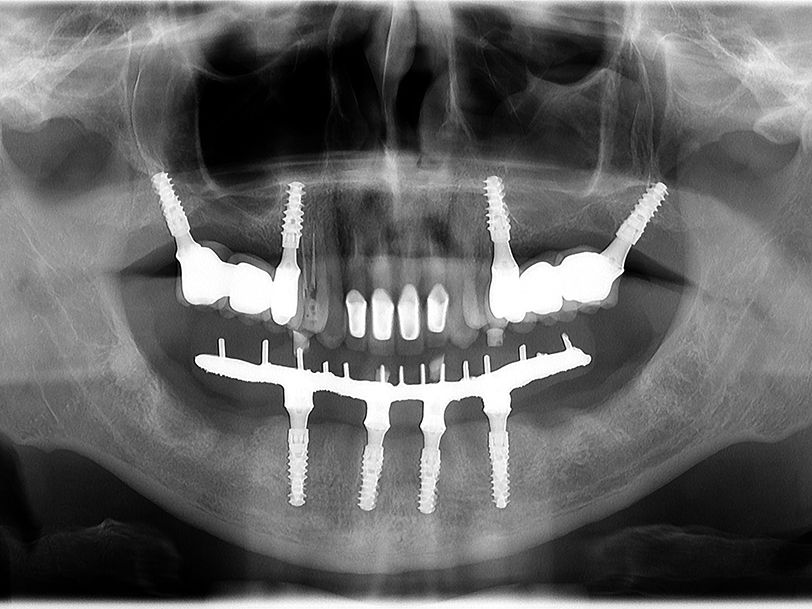 Maxillary Tuberosity Radiograph