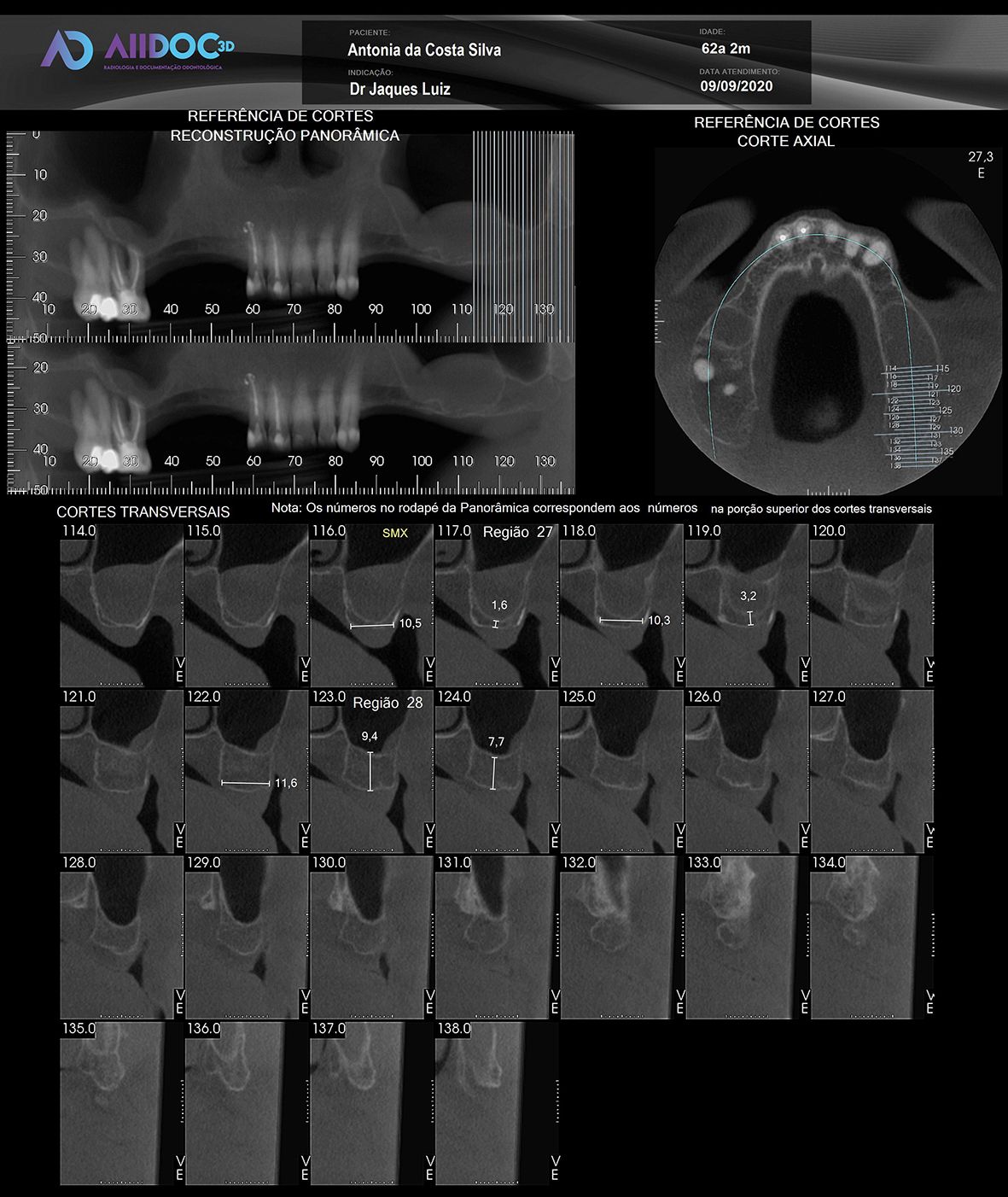 maxillary tuberosity reduction
