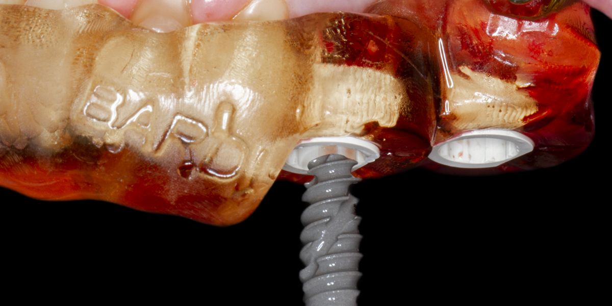 Three-unit bridge in the posterior area with Straumann® BLX implants ...