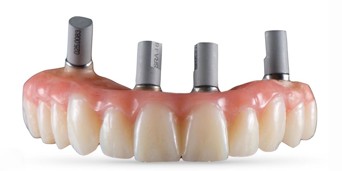 Immediate fixed rehabilitation of maxilla using Straumann® Pro Arch ...