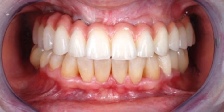 Use of TLX short implants and teeth-supported provisional restoration ...
