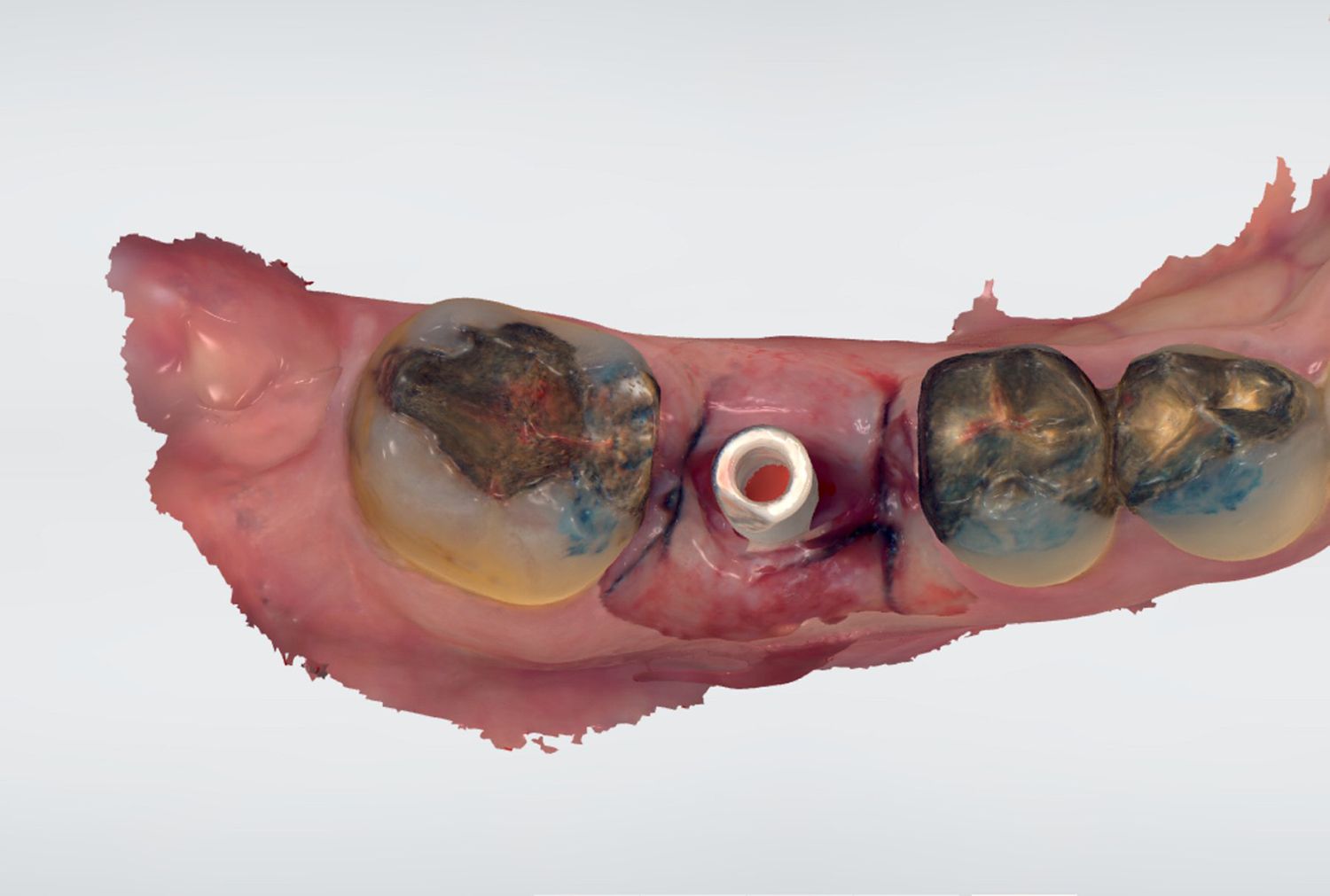 Digitale und analoge Abformungen für eine starke Implantatprothetik