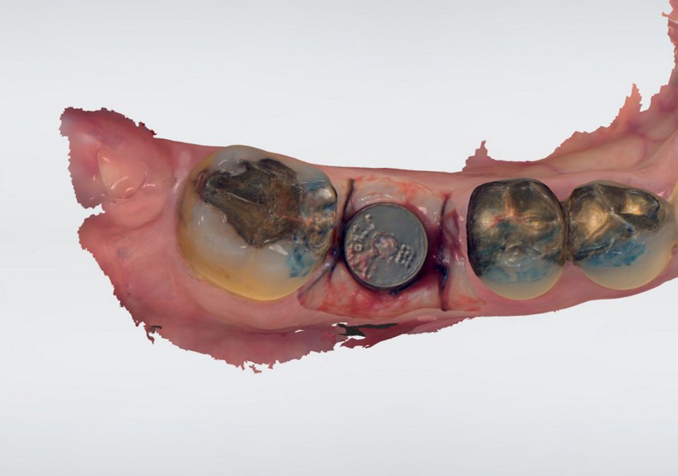 Digitale und analoge Abformungen für eine starke Implantatprothetik