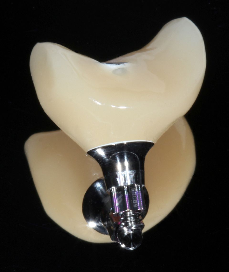 Digitale und analoge Abformungen für eine starke Implantatprothetik